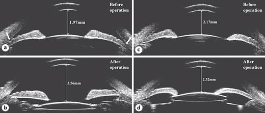 Ocular Characteristics of Pseudophakic Eyes with Malignant Glaucoma ...