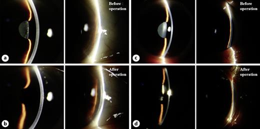 Ocular Characteristics of Pseudophakic Eyes with Malignant Glaucoma ...