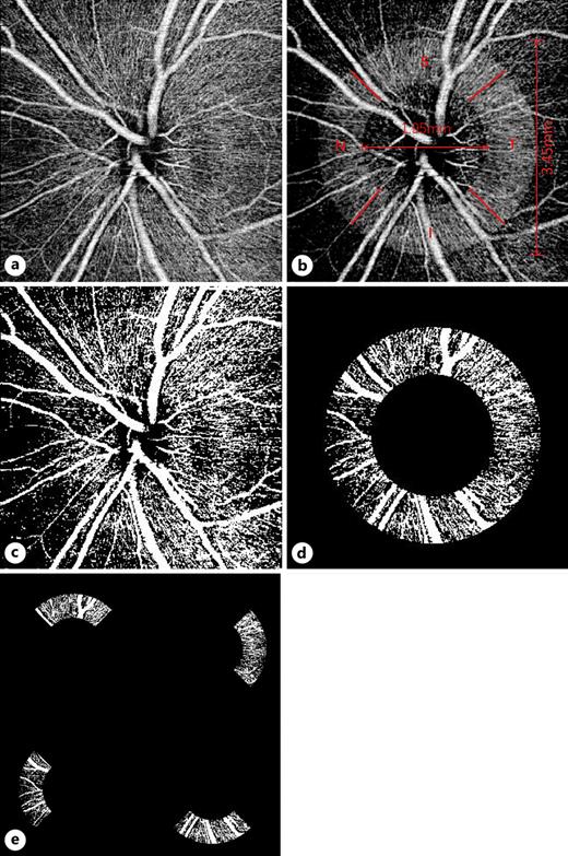 Changes of Optic Disc and Macular Vessel Perfusion Density in Primary ...