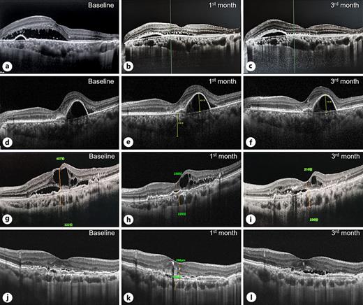 Evaluation of the First-Dose Anti-VEGF Anatomical Response in ...