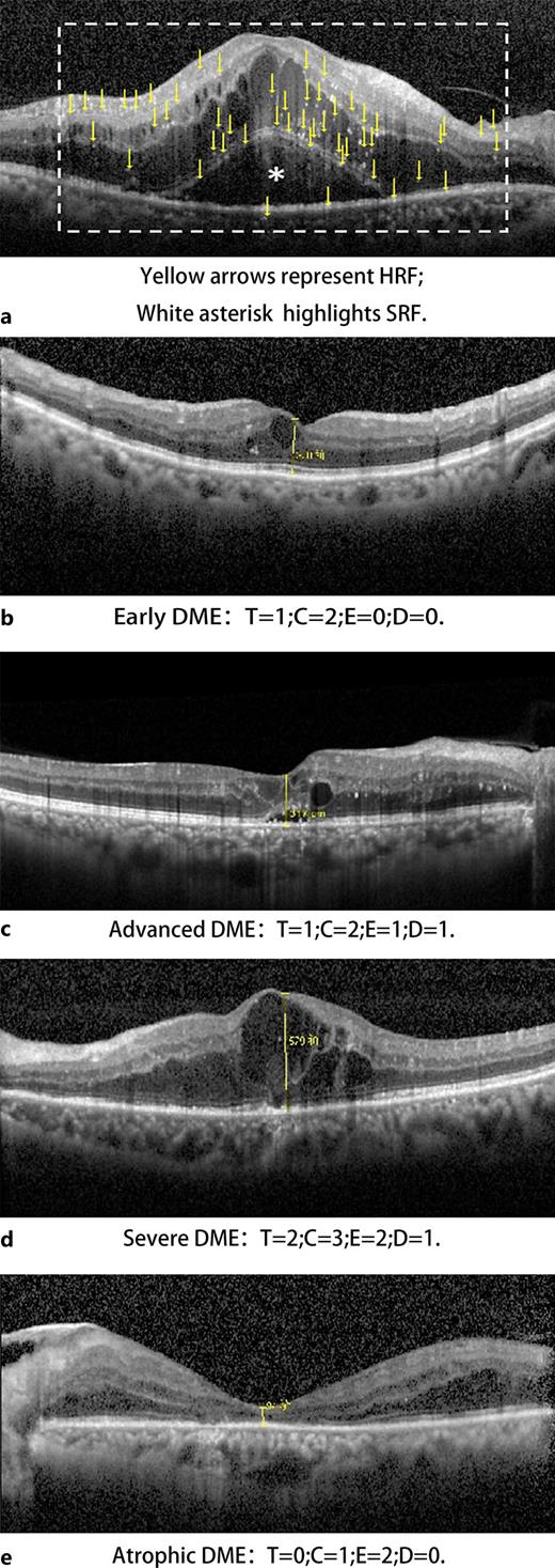 Optical Coherence Tomography-Based Grading of Diabetic Macular Edema Is ...