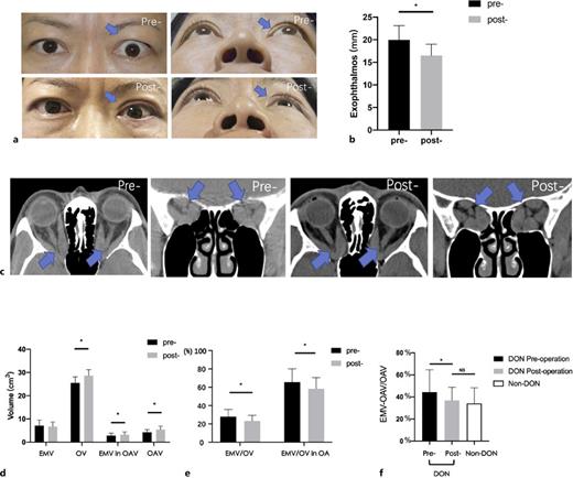 Surgical Outcomes of Standardized Endoscopical Deep Medial Orbital ...