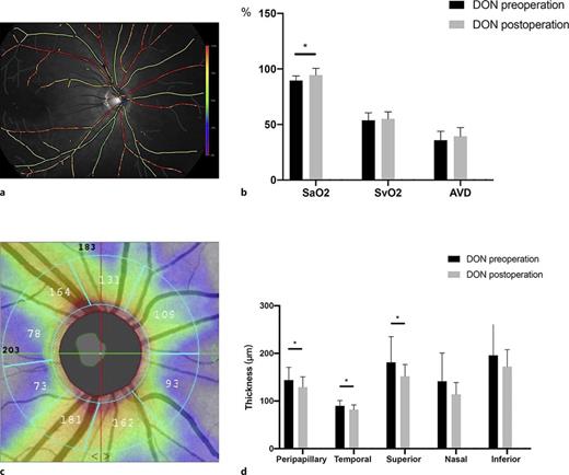 Surgical Outcomes of Standardized Endoscopical Deep Medial Orbital ...