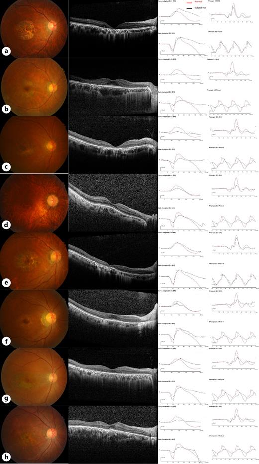 Phenotypic and Genetic Alterations in Adult-Onset Cone and Cone-Rod ...