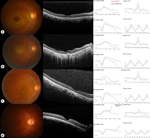 Phenotypic and Genetic Alterations in Adult-Onset Cone and Cone-Rod ...