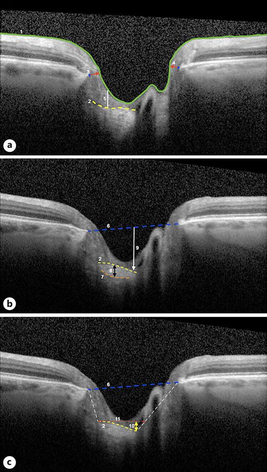 Differentiating Ischemic Optic Neuropathy from Glaucoma Using ...