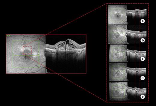 Effect of Pro Re Nata Regimen with Anti-VEGF on Type 3 Macular ...