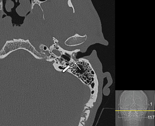 Taste Alteration in External Auditory Canal Cholesteatoma: Indicator of ...