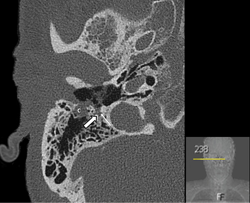 Taste Alteration in External Auditory Canal Cholesteatoma: Indicator of ...