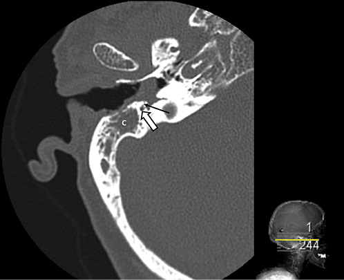 Taste Alteration in External Auditory Canal Cholesteatoma: Indicator of ...