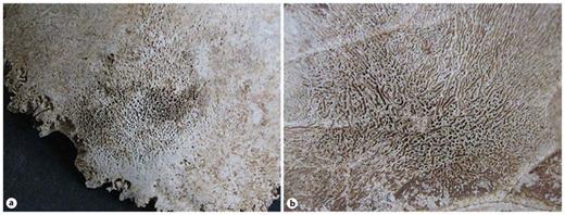 Palaeopathology of Human Remains from the Roman Imperial Age ...