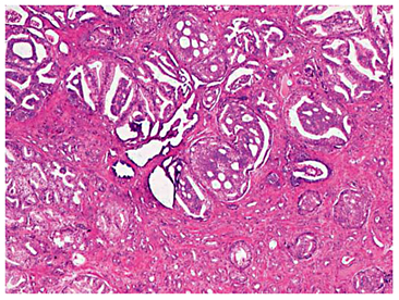 The Heterogeneity of Prostate Cancer: A Practical Approach ...