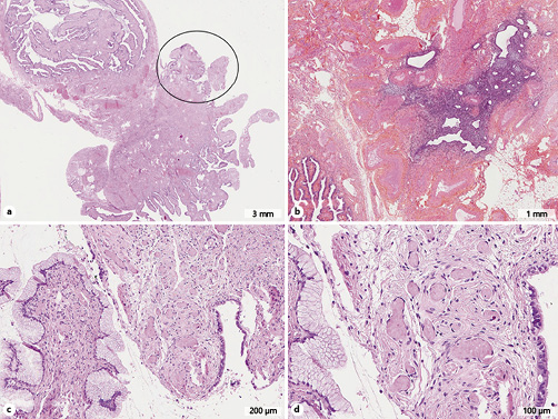 Pathology of the Fallopian Tube: Tubal Involvement by Ovarian Tumors ...