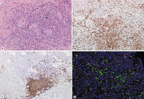 The Immune Microenvironment in Breast Carcinoma: Predictive and ...