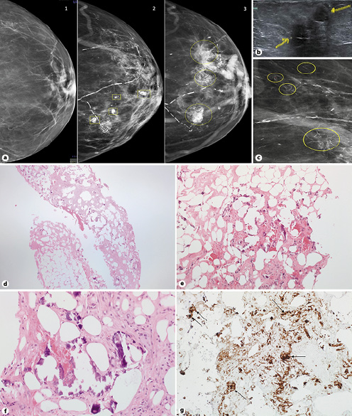 Unusual Presentation of Mammary Calciphylaxis in a Patient on Long ...