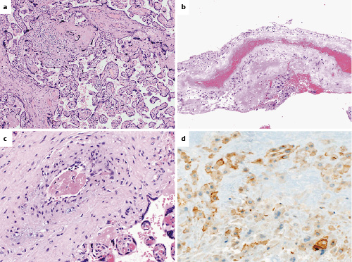 Placental Pathology Findings during and after SARS-CoV-2 Infection ...
