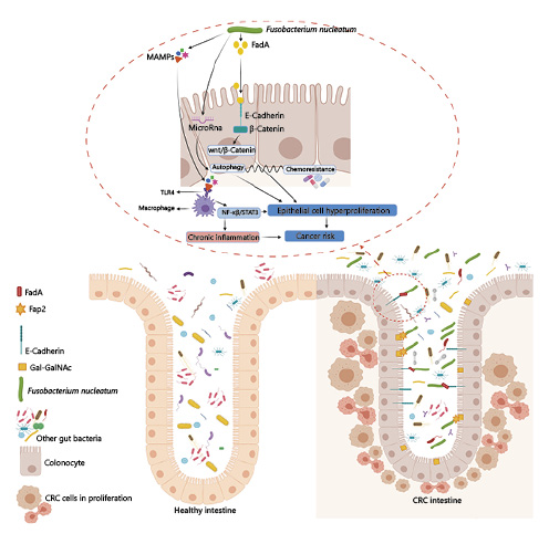 The Role of Fusobacterium nucleatum in Colorectal Carcinogenesis ...