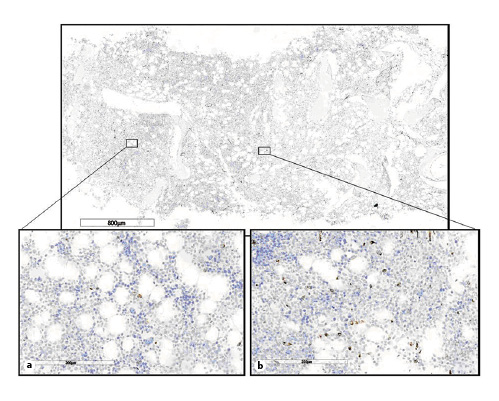 CD34-Positive Blast Count and p53 Expression in Bone Marrow Biopsies of ...