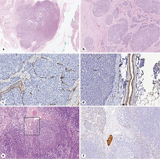 Solid Papillary Carcinoma and Encapsulated Papillary Carcinoma of the ...