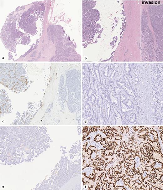 Solid Papillary Carcinoma and Encapsulated Papillary Carcinoma of the ...
