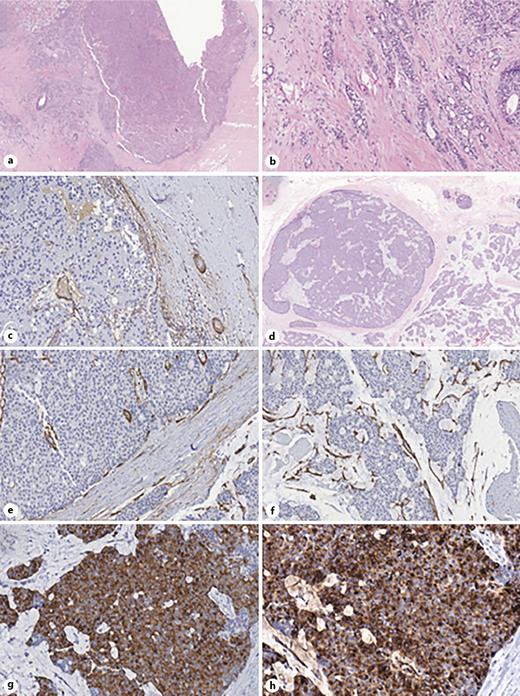 Solid Papillary Carcinoma and Encapsulated Papillary Carcinoma of the ...