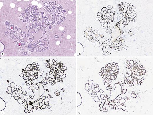 Quality Issues in Diagnostic Immunohistochemistry in Breast Pathology ...
