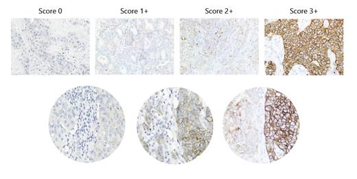 Unusual Patterns of HER2 Expression in Breast Cancer: Insights and ...