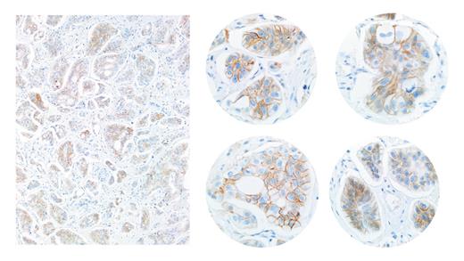 Unusual Patterns of HER2 Expression in Breast Cancer: Insights and ...