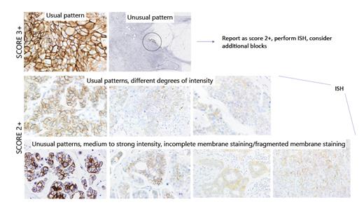Unusual Patterns of HER2 Expression in Breast Cancer: Insights and ...