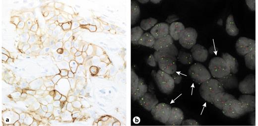 Unusual Patterns of HER2 Expression in Breast Cancer: Insights and ...