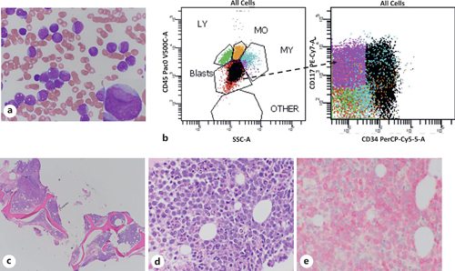 NPM1-Mutated Acute Myeloid Leukemia: Recent Developments and Open ...