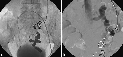 Treating Untreatable Rectal Varices | GE - Portuguese Journal of ...