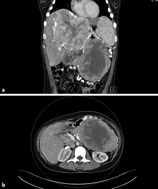 Solid Pseudopapillary Neoplasm of the Pancreas: Unfolding an Intriguing ...