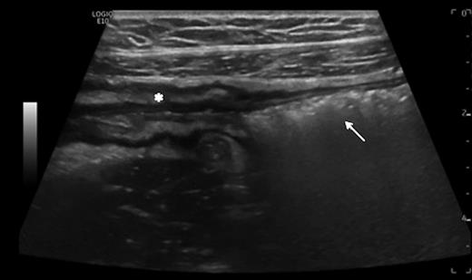Intestinal Ultrasound in Inflammatory Bowel Disease: A Valuable and ...