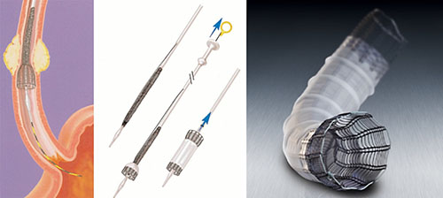 Esophageal Stenting: How I Do It | GE - Portuguese Journal of ...