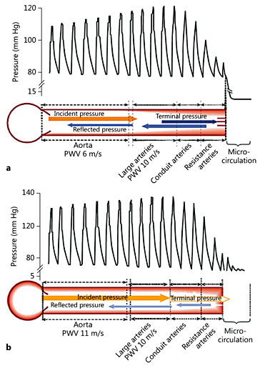 Arterial Stiffness Gradient | Pulse | Karger Publishers