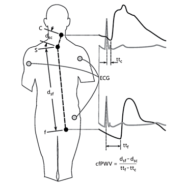 Large Artery Stiffness Assessment Using SphygmoCor Technology | Pulse | Karger Publishers