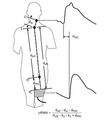 Large Artery Stiffness Assessment Using SphygmoCor Technology | Pulse | Karger Publishers