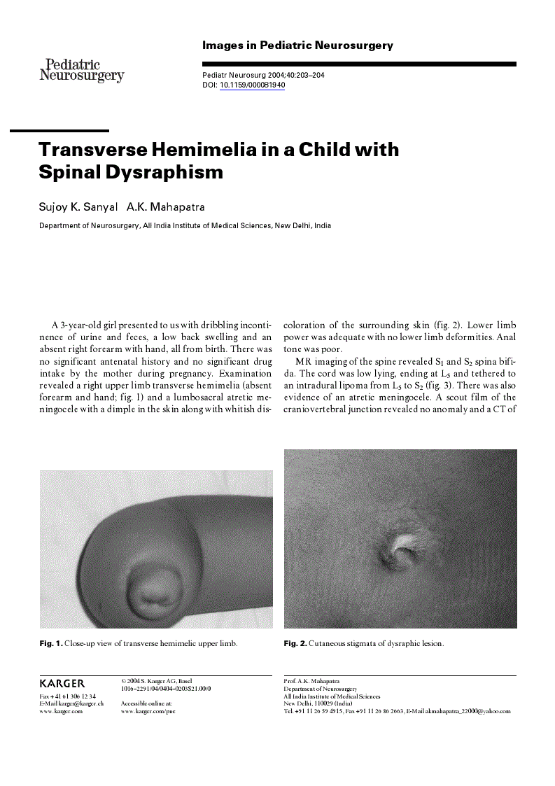 Transverse Hemimelia in a Child with Spinal Dysraphism | Pediatric ...