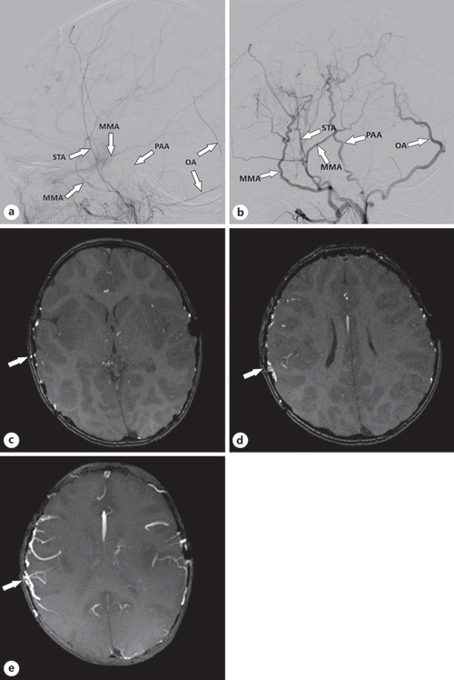 Use of the Posterior Auricular Artery for Indirect Bypass in Moyamoya ...
