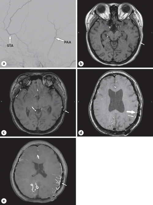 Use of the Posterior Auricular Artery for Indirect Bypass in Moyamoya ...