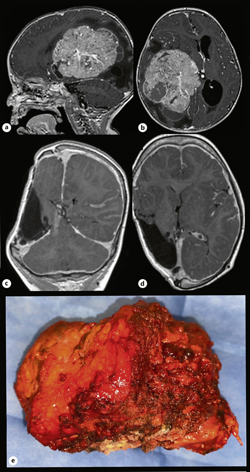 Giant Supratentorial Brain Tumors in Children: Functional Outcome and ...
