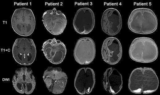 Serial Neuroendoscopic Lavage for the Treatment of Elevated ...