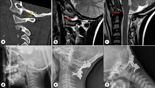 Pediatric Cervical Spine Trauma: Injury Patterns, Diagnosis, and ...