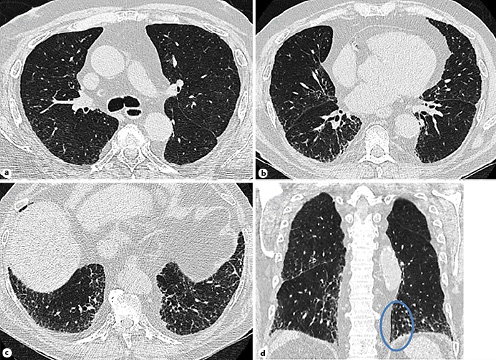 S2K Guideline for Diagnosis of Idiopathic Pulmonary Fibrosis ...