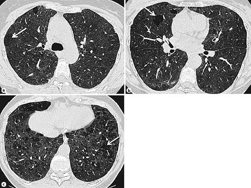 S2K Guideline for Diagnosis of Idiopathic Pulmonary Fibrosis ...