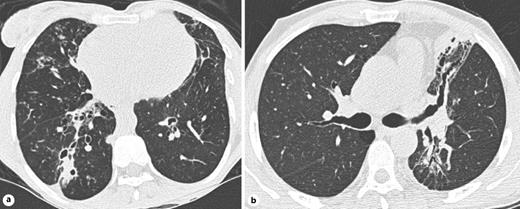 Post-Tuberculosis Lung Disease: Clinical Review of an Under-Recognised ...