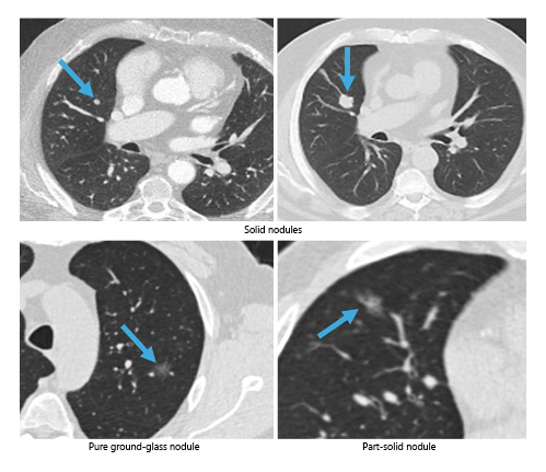 Incidental Pulmonary Nodules – What Do We Know in 2022 | Respiration ...