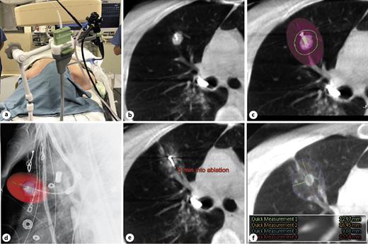 Novel Image-Guided Flexible-Probe Transbronchial Microwave Ablation for ...