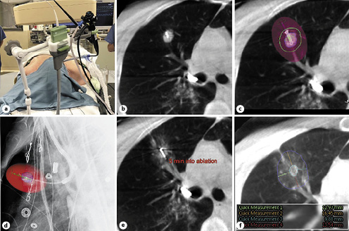 Novel Image-Guided Flexible-Probe Transbronchial Microwave Ablation for ...